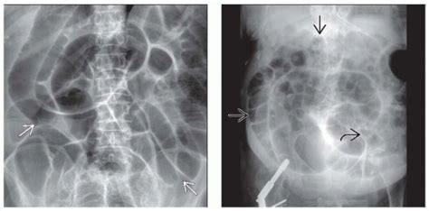 Ileus Radiology Key