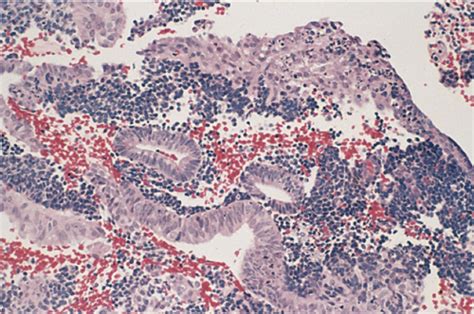 Uterine Pathology Flashcards Quizlet