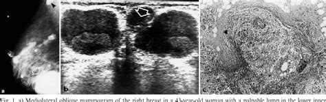 Figure 1 From Differentiation Of Phyllodes Tumors Versus Fibroadenomas