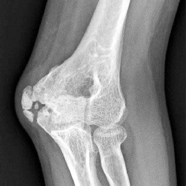 After Medial Epicondylectomy The Immediate Postoperative Radiograph