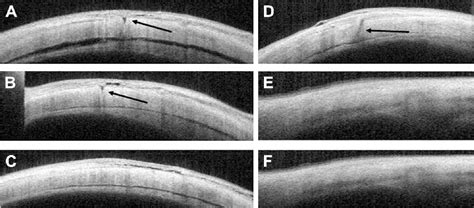 Figure 3 From Comparative Study Of Straight Vs Angled Incision In 27