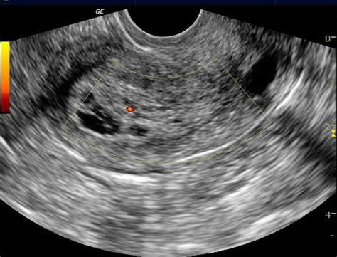 Apa Itu Endometrial Hyperplasia Best Home Design Ideas