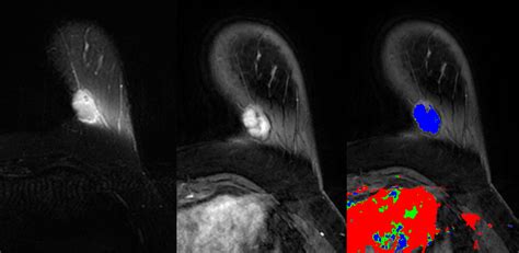 Mri Dermatofibrosarcoma Protuberans Breast Rads