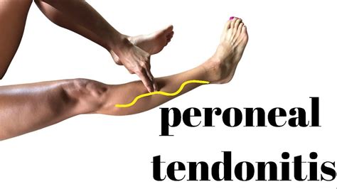 Peroneal Tendonitis Causes And Symptoms Cap Health Mag