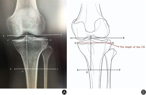 Proximal Tibia Anatomy