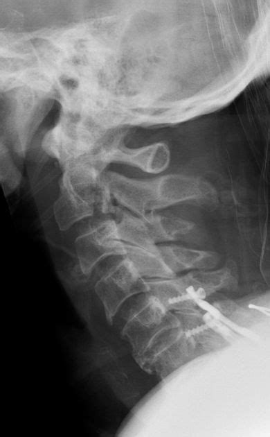 Hangman Fracture Radiology Case A Fracture