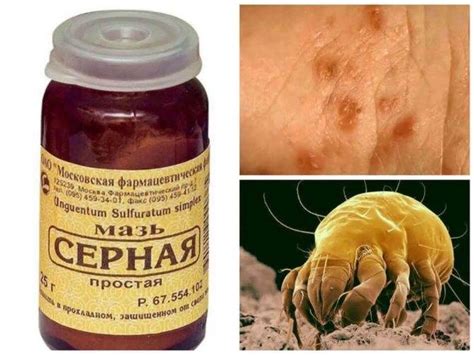 Лечение чесотки в домашних условиях