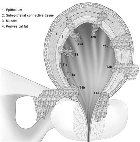 Tnm And Staging Of Urinary Bladder Cancer Simplified Epomedicine