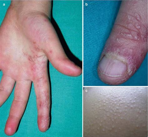 Nevoid Skin Disorders Plastic Surgery Key