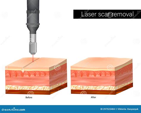 Laser Scar Removal Before And After Laser Scar Reduction Scar