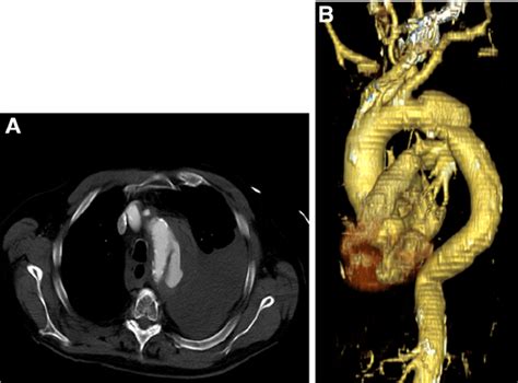 A B Computed Tomography Scans Obtained At Admission Ruptured