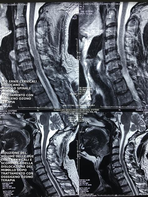 Ernia Del Disco Lombare E Cervicale Ozono Terapia Roma