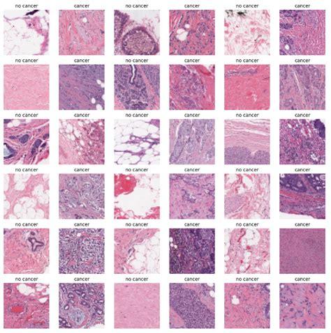 Github Narc Kany Breast Cancer Detection Using Breast Histopathology