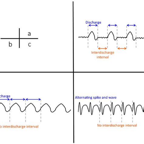 Eeg Pattern Associated With Ncse A Periodic Discharges B Rhythmic