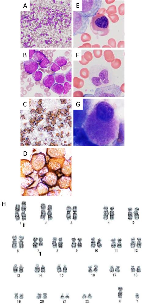 Figure1morphological Findings And Genetic Analyses Of Bone Marrow