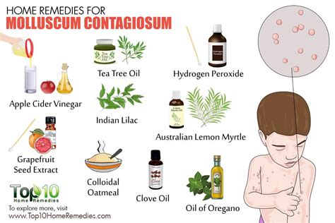 Home Remedies For Molluscum Contagiosum Top 10 Home Remedies