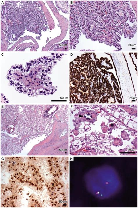 He Stained Sections Illustrate Clear Cell Papillary Rcc With A