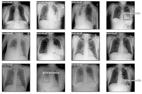 Detecting Pneumonia In Chest Radiographs With Fast Ai