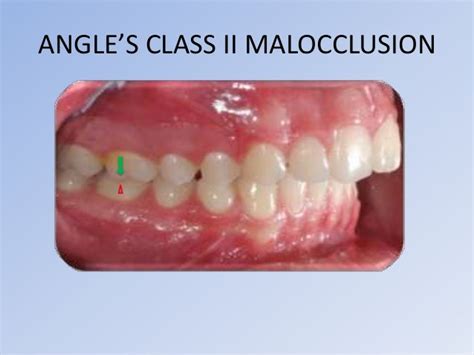 Angles Classification Of Malocclusion