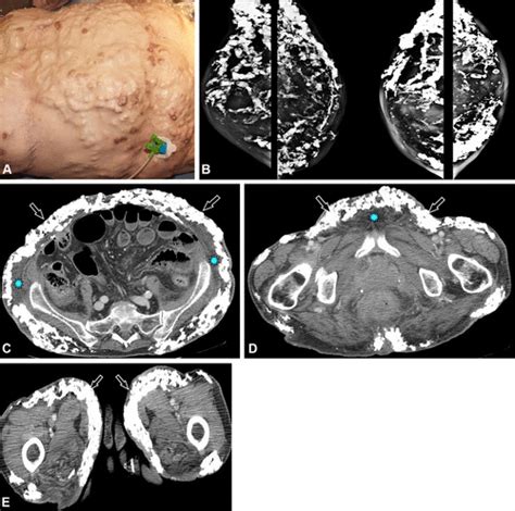 Calcinosis Cutis Dermatomyositis RadioGraphics