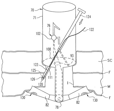 Laparoscopic Port Patented Technology Retrieval Search Results Eureka Patsnap