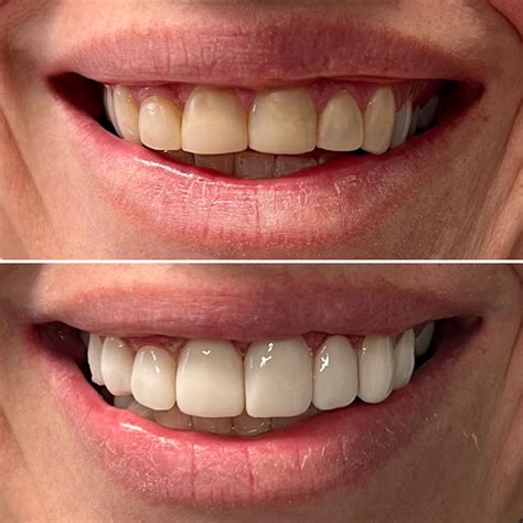 Bioclear Before And After Boulton Dental
