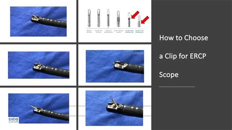 Endoscopic Management Of Post Sphincterotomy Bleeding Eight Hemostatic Tips