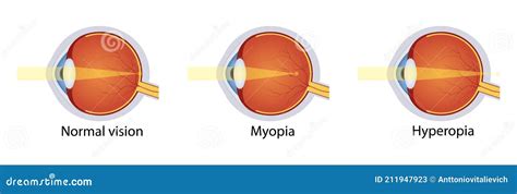Normal Vision Hyperopia Myopia Set Of Vision Disorders Anatomy Of Eyeball Defect Vector