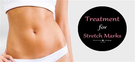 Stretch Marks Causes Prevention Remedies And Treatment Heart Bows