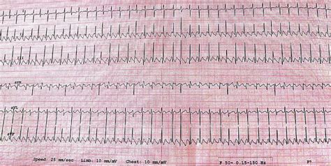 Sawtooth” Pattern In Ecg