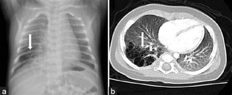 Type Ii Congenital Cystic Adenomatoid Malformation Cpam In A Download Scientific Diagram