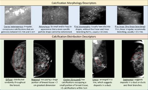 Examples Of Morphology And Distribution Types Types Of Suspicious