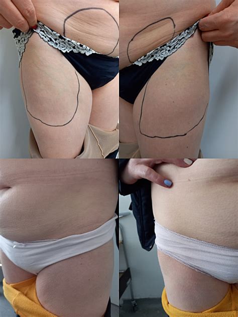Somapacitan Induced Reversible Lipoatrophy In An Adult Woman With