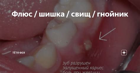 Флюс / шишка / свищ / гнойник 🦷 | Тëтя Фея | Дзен