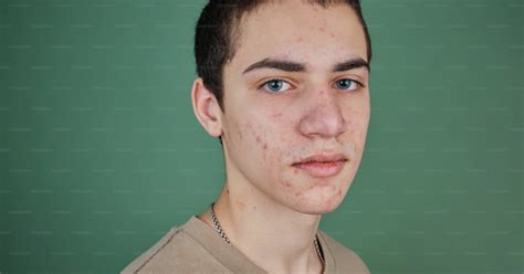 Un Joven Con Pecas En La Cara Foto Imagen De Acné En Unsplash