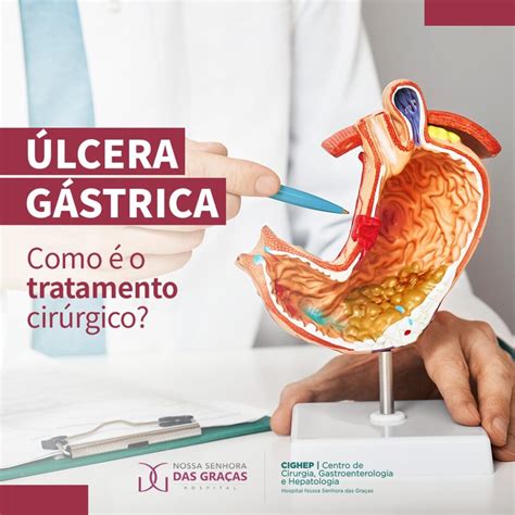 Úlcera Gástrica Como é O Tratamento Cirúrgico Cighep