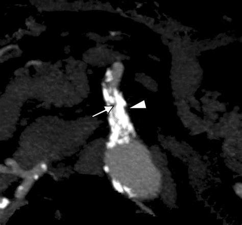Cta And Mra In Mesenteric Ischemia Part 1 Role In Diagnosis And Differential Diagnosis Ajr