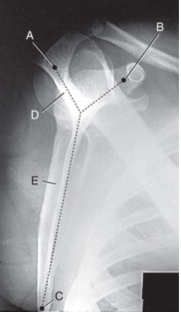 Diagram Of Pa Oblique Shoulder Scapular Y Radiograph Quizlet