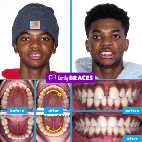 Braces Before And After Gap