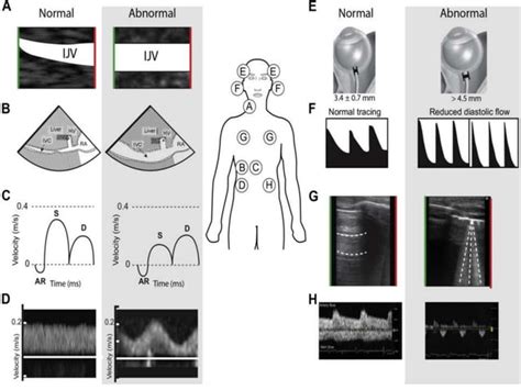 Basic Ultrasound In Icu Pptx