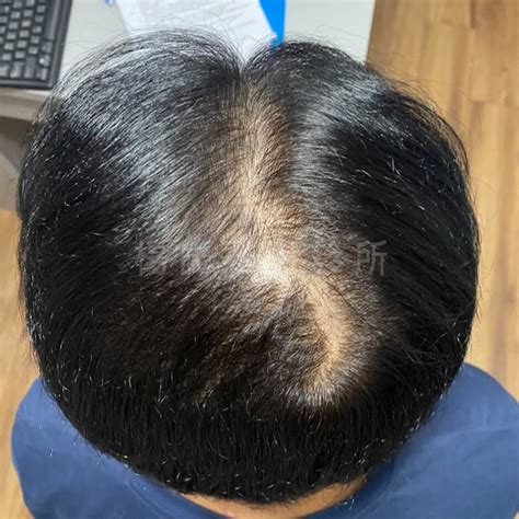 【複合式生髮】免植髮解除禿頭危機，實現頭髮茂密心願 楊氏診所 Udn部落格