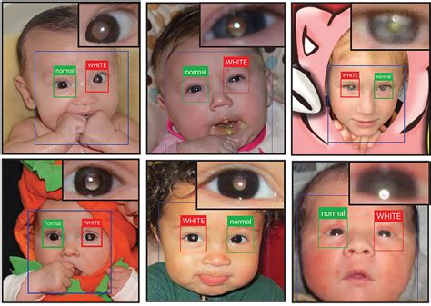 Retinoblastoma Symptoms