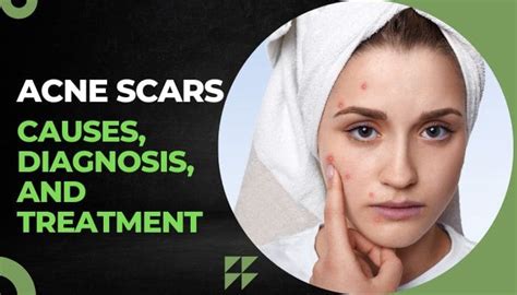 Acne Scars Causes Diagnosis And Treatment