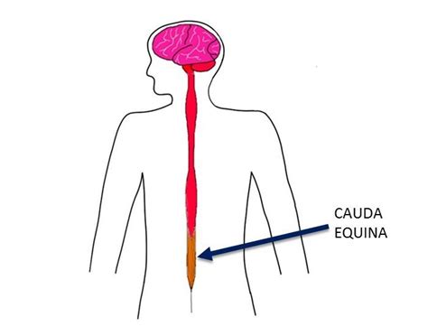 Cauda Equina Definition