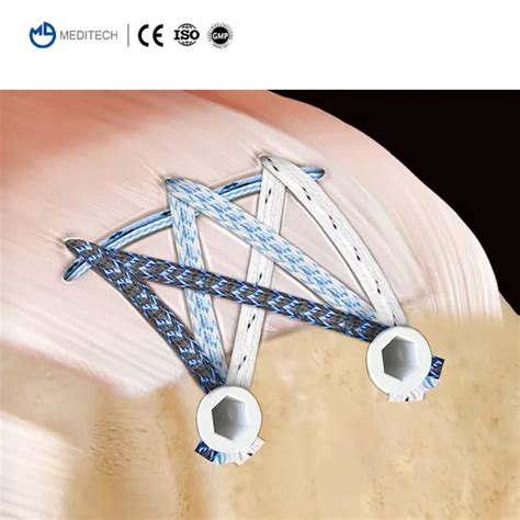 All Suture Anchor Absorbable Suture Anchor Achilles Tendon Suture