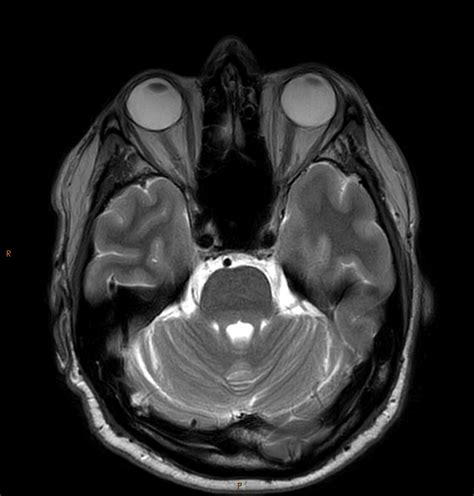 Filediffuse Astrocytoma Idh Mutant Radiopaedia 98918 120113 Axial 15