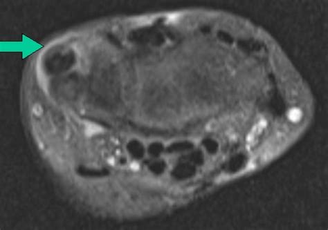 Mricases Extensor Carpi Ulnaris Tenosynovitis