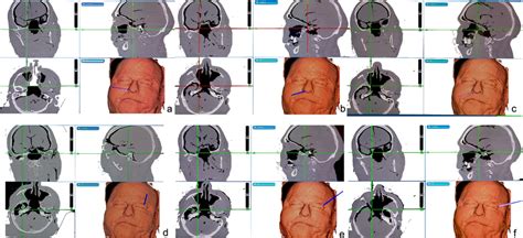 Imagine Guidance From Neuronavigation System Showing Measurements Of