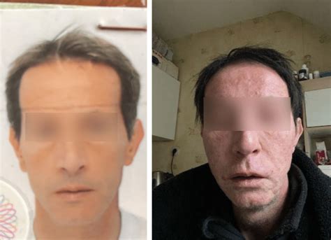 TÉmoignage Victime Dinjections Illégales De Botox Jirai Jusquau