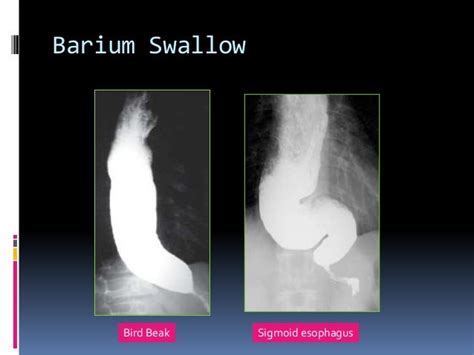 Role Of Endoscopy In Achalasia And Gerd